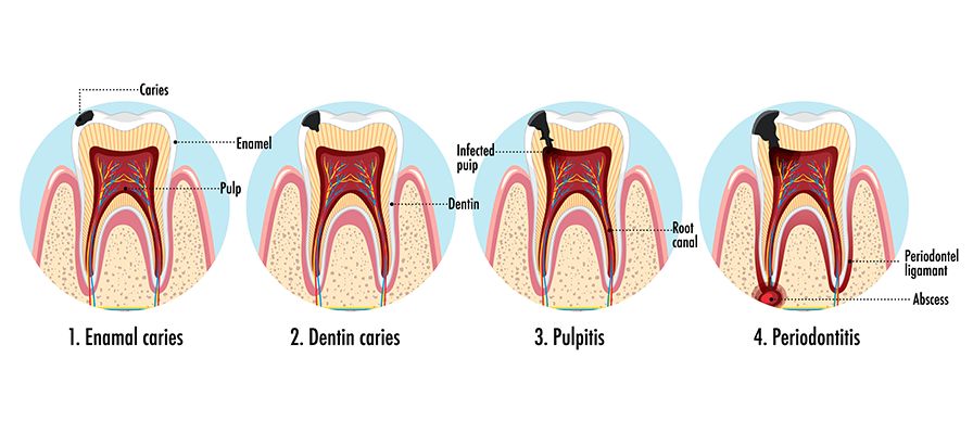 Stages Of Tooth Decay And Abscesses | Vital Dental