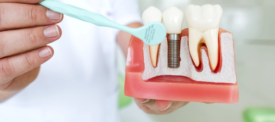 Will My Insurance Cover Dental Implants? Know Your Options